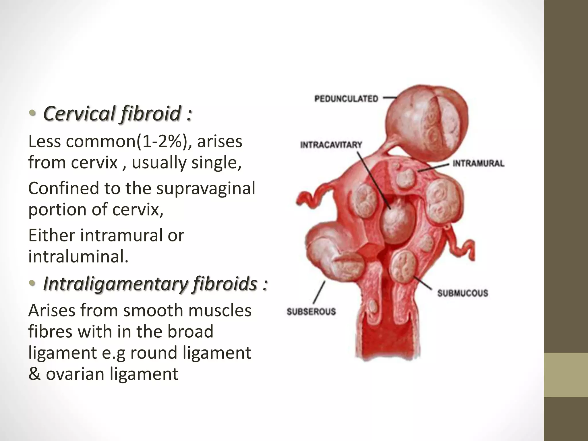 Fibroid uterus by Dr waseem sajjad | PPTX