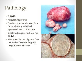 Fibroid uterus by Dr waseem sajjad | PPTX