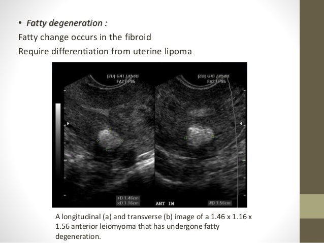 Fibroid uterus by Dr waseem sajjad