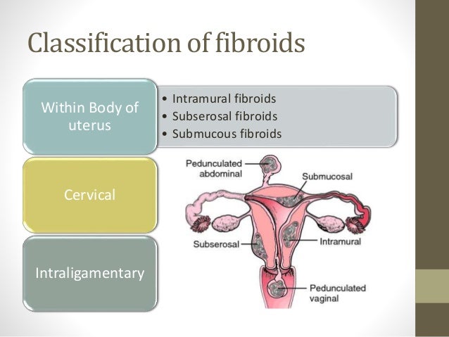 Fibroid uterus by Dr waseem sajjad
