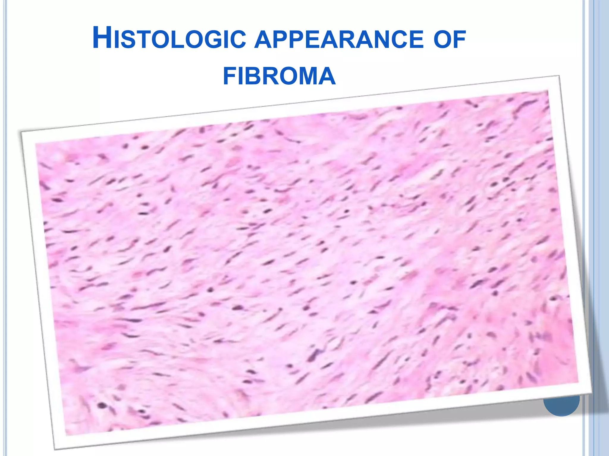 Fibroma- benign tumors | PPTX | Dental Health | Diseases and Conditions