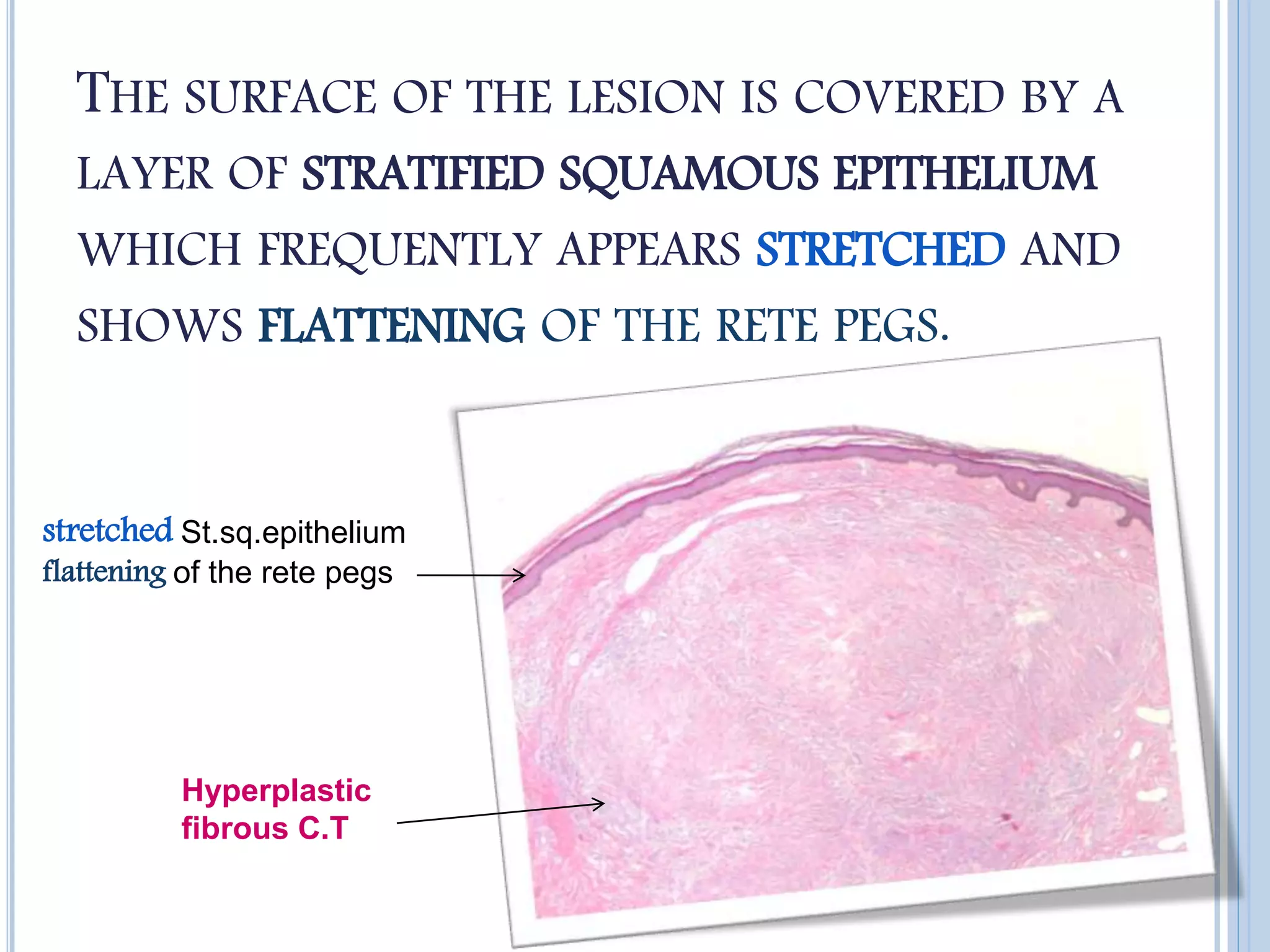 Fibroma- benign tumors | PPTX