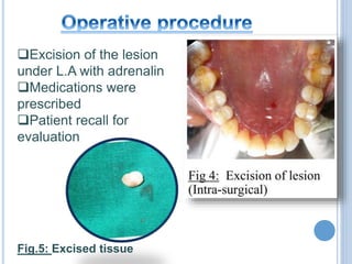 Fibroma- benign tumors | PPTX