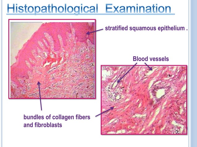 Fibroma- benign tumors | PPTX | Dental Health | Diseases and Conditions