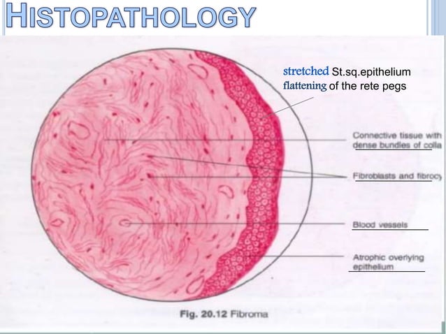 Fibroma- benign tumors | PPTX | Dental Health | Diseases and Conditions
