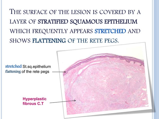 Fibroma- benign tumors | PPTX | Dental Health | Diseases and Conditions