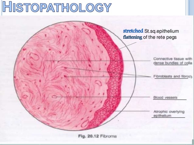Fibroma- benign tumors