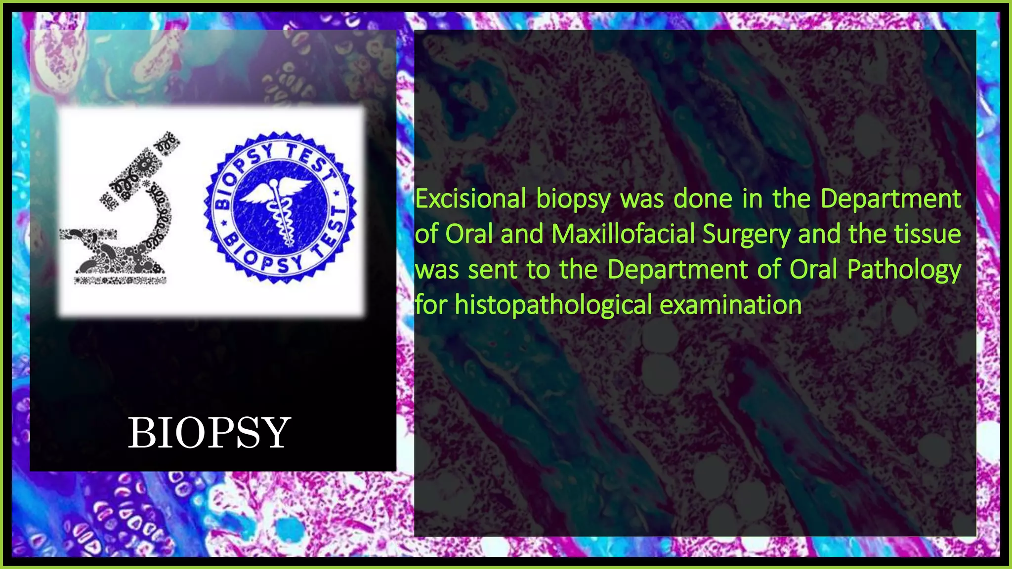 Fibroma | PPTX