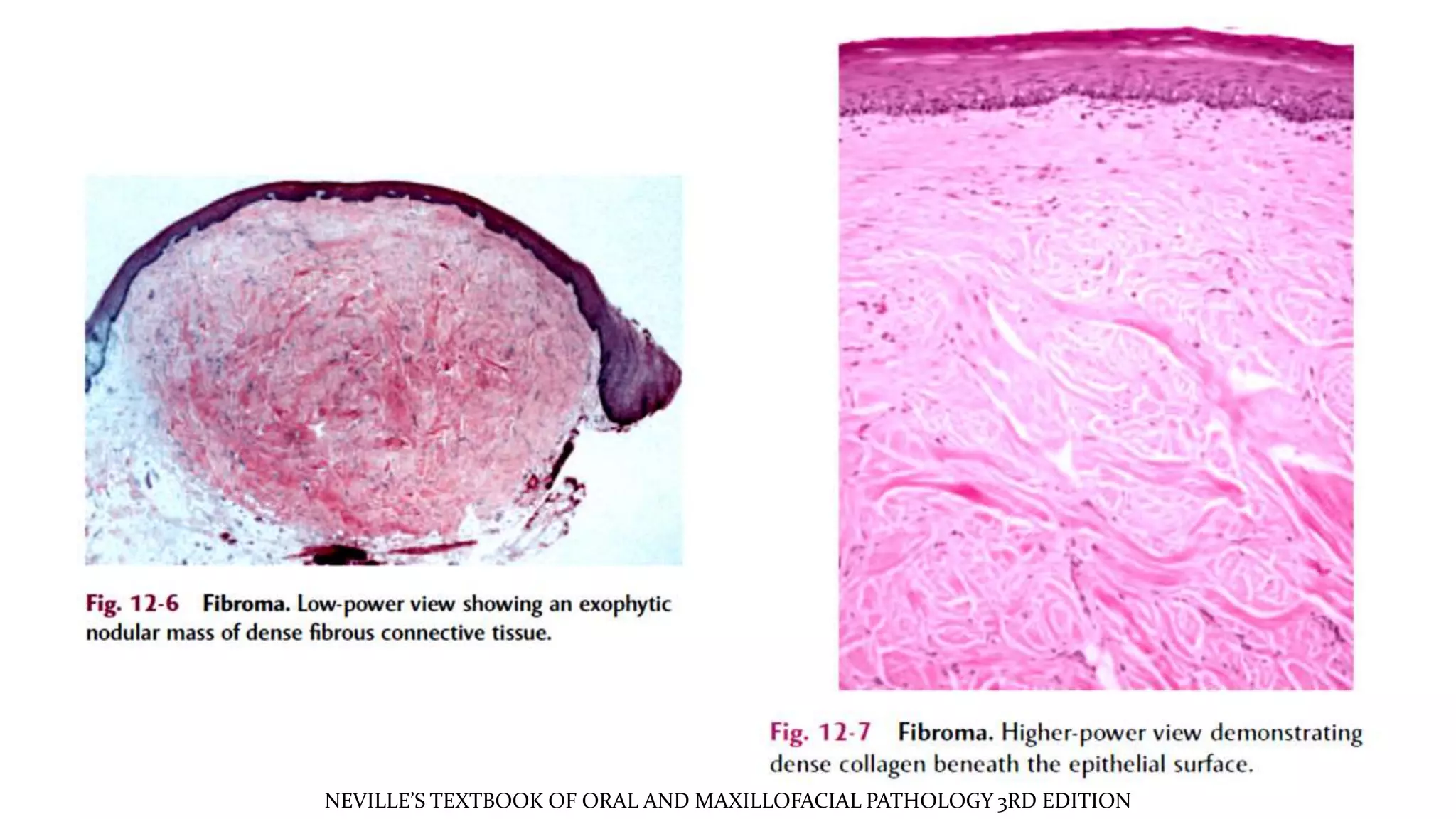 Fibroma | PPTX