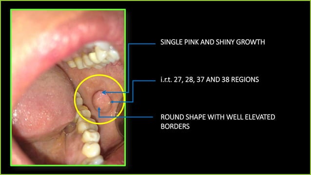 Fibroma | PPTX