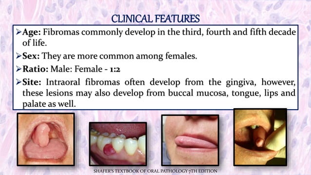 Fibroma | PPTX