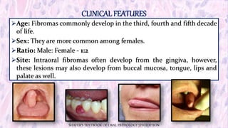 Fibroma | PPT