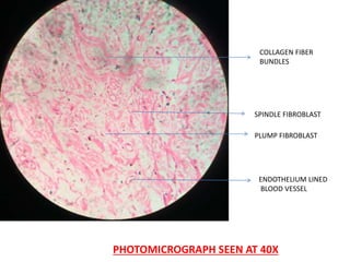 Fibroma case presentation | PPTX