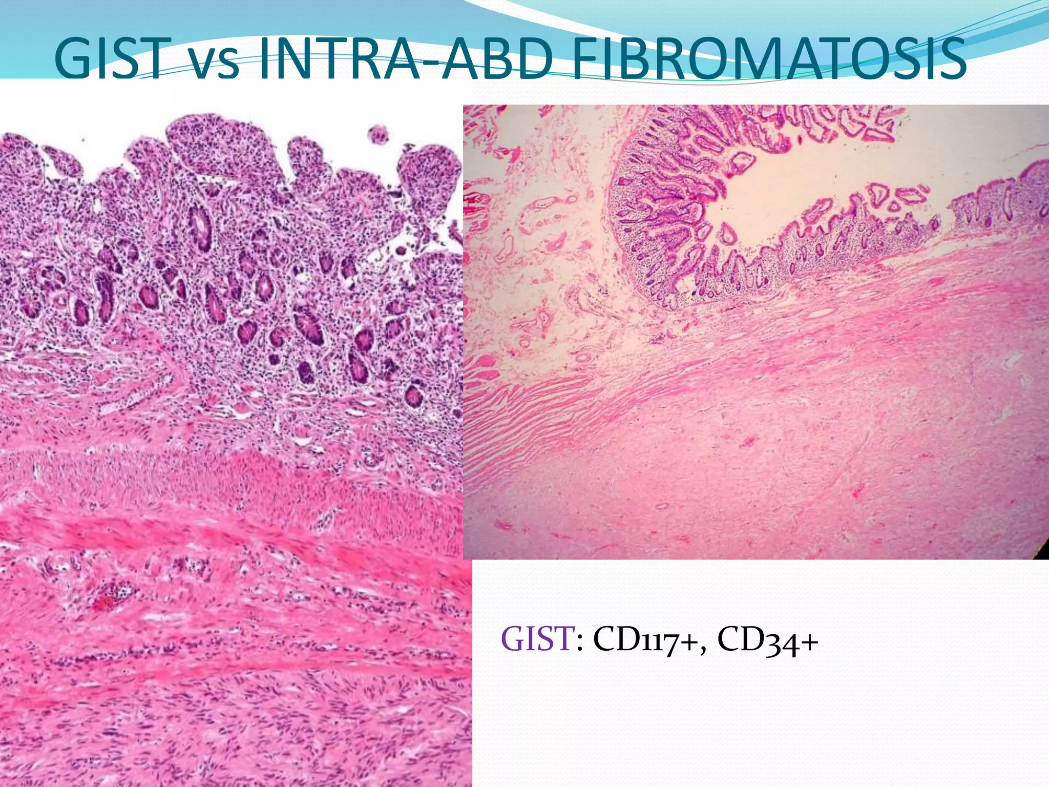 Abdominal Fibromatosis ah 2017 | PPT