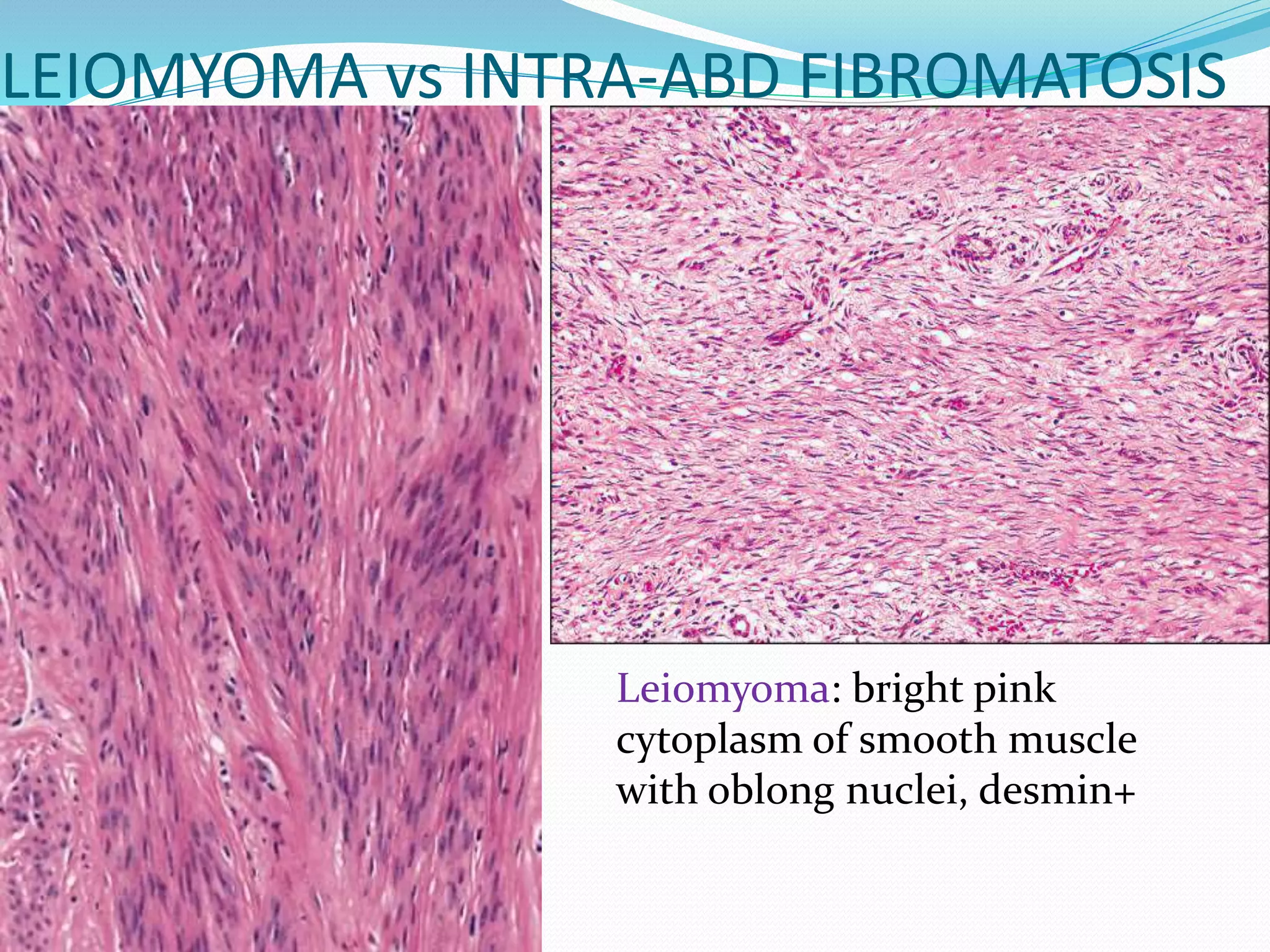 Abdominal Fibromatosis ah 2017 | PPT