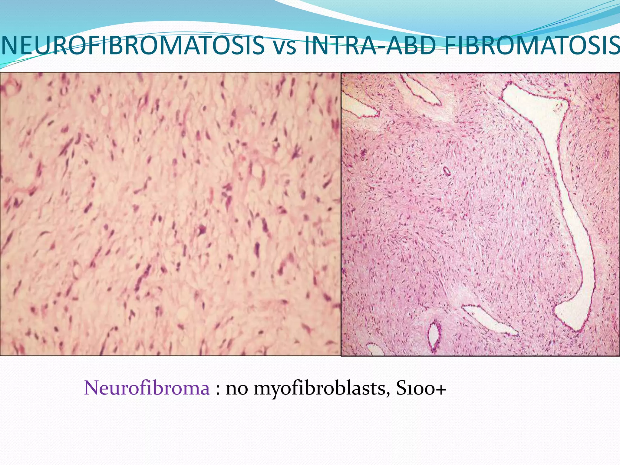 Abdominal Fibromatosis ah 2017 | PPT