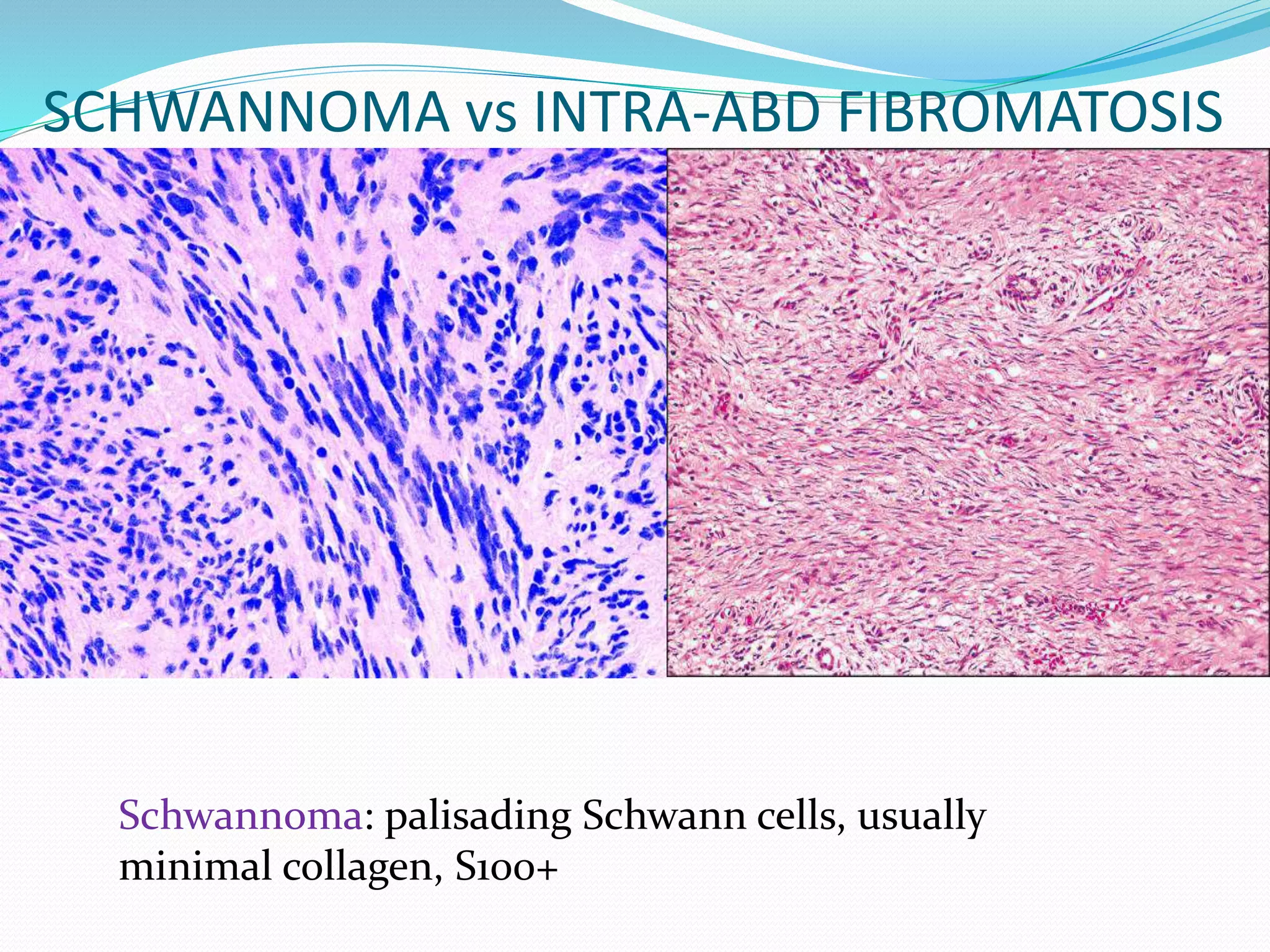 Abdominal Fibromatosis ah 2017 | PPT