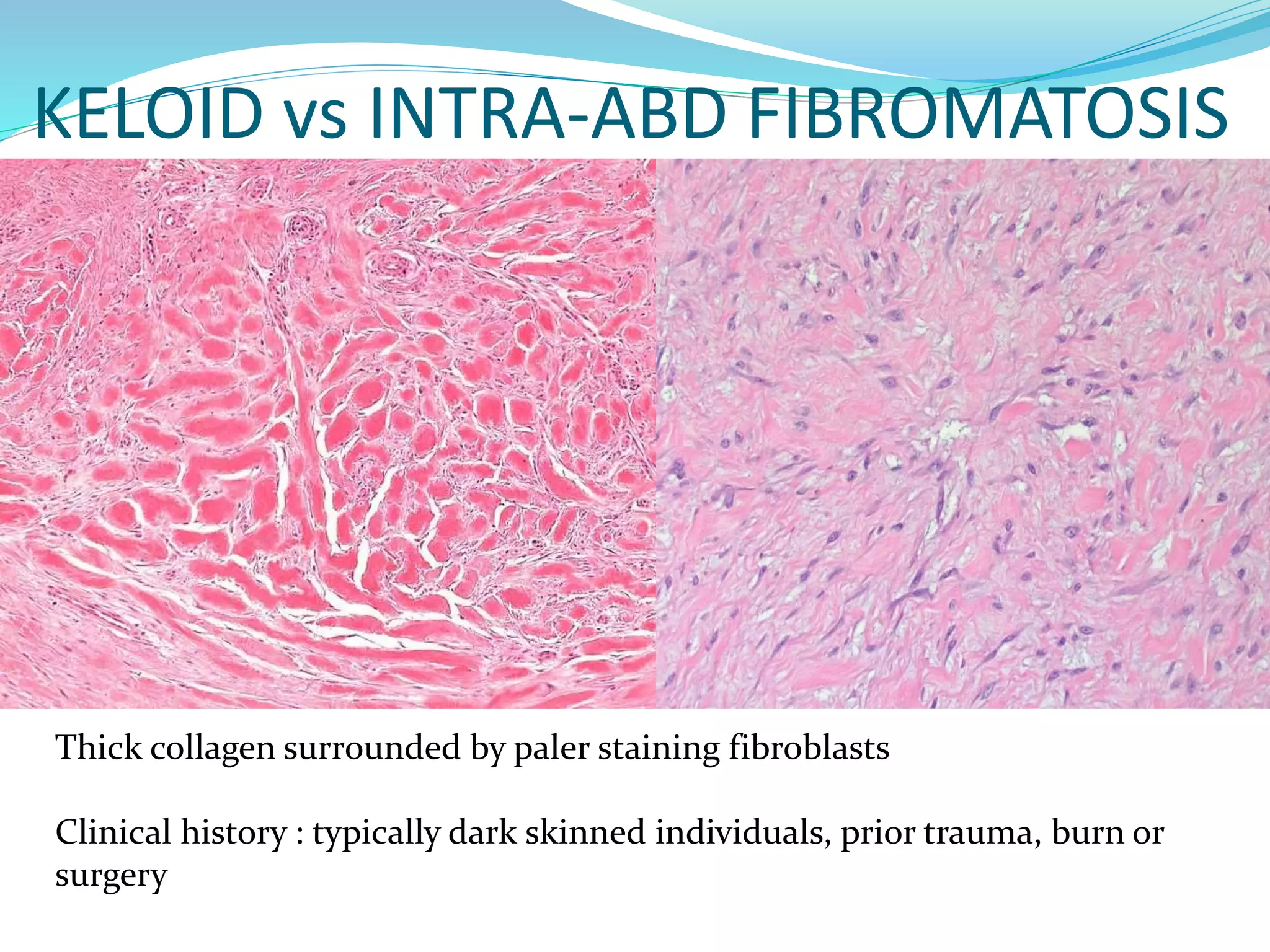 Abdominal Fibromatosis ah 2017 | PPT