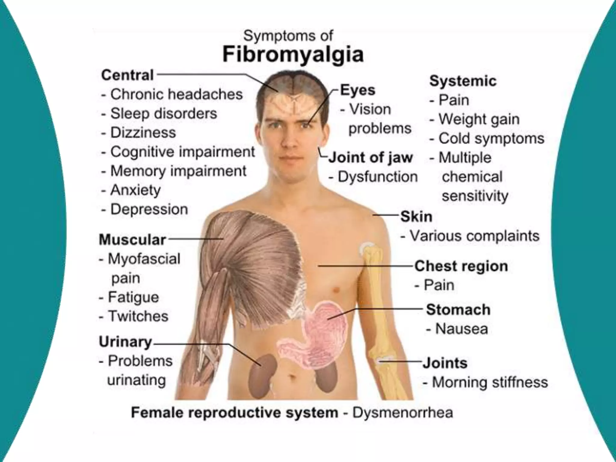 What is Fibromyalgia? | PPTX