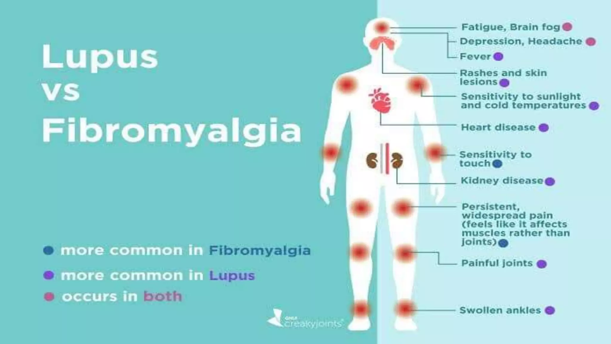 Fibromyalgia - medical information | PPT