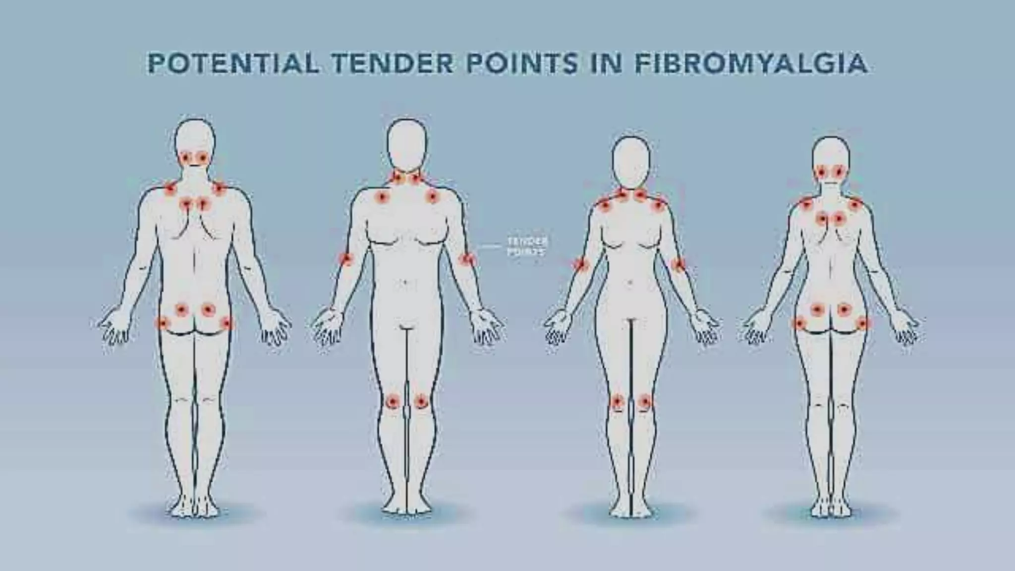 Fibromyalgia - medical information | PPT