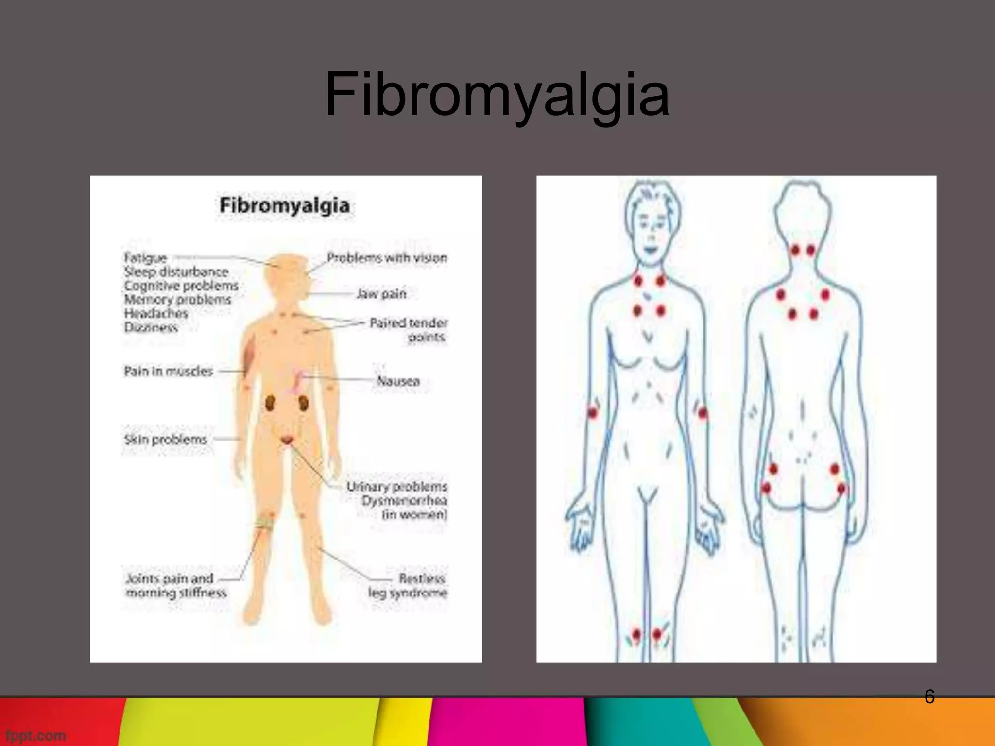 Fibromyalgia | PPT