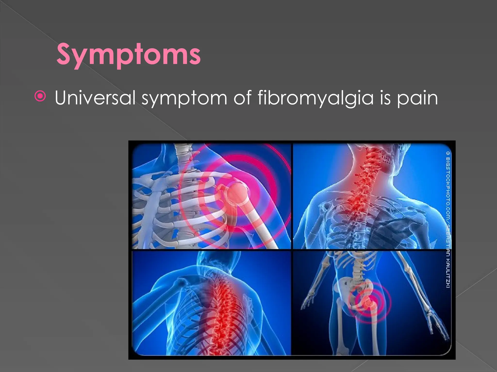 FIBROMYALGIA- Introduction, definition, causes, sign and symptoms ...