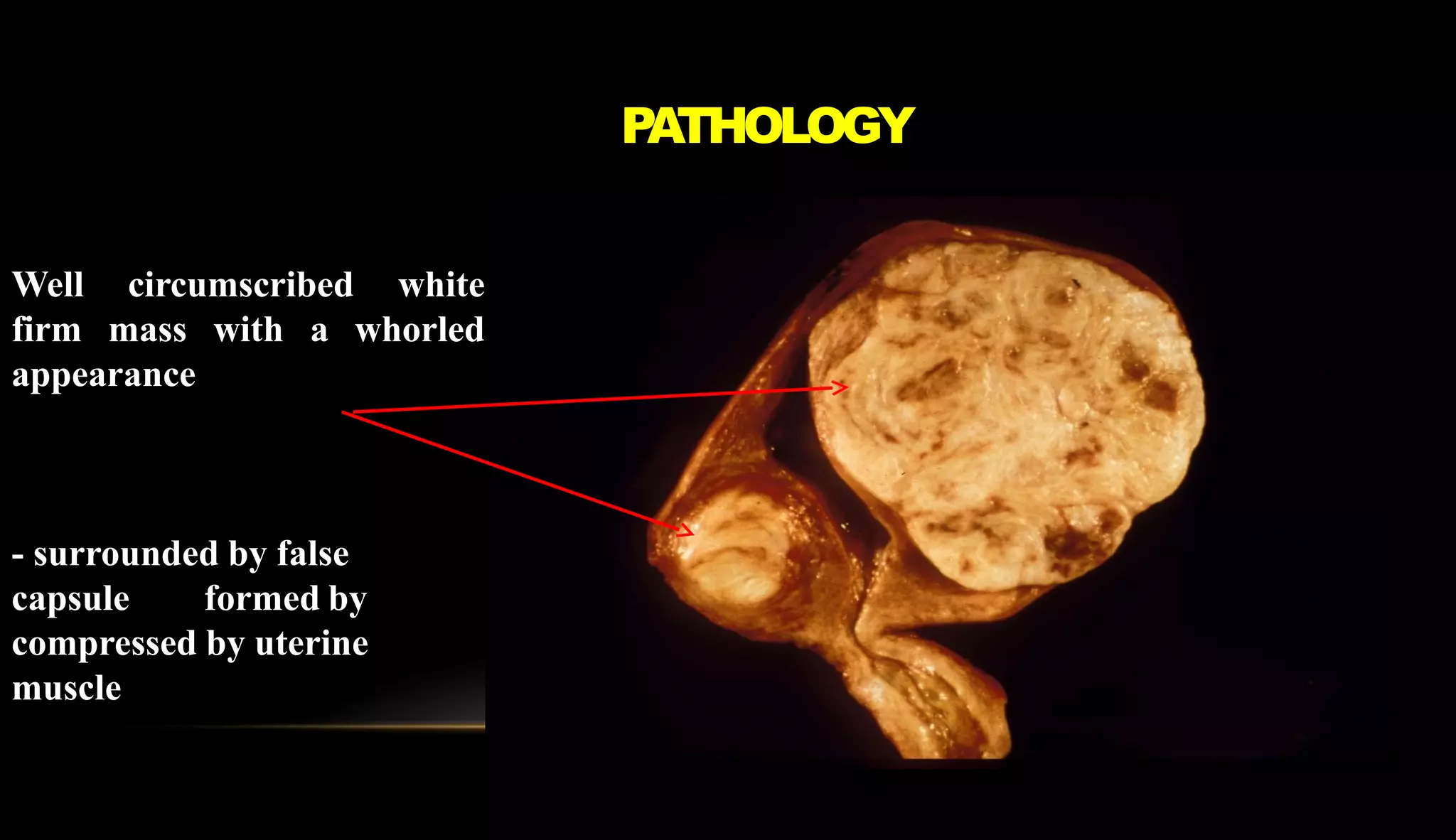 Fibromyoma uterus by Dr. H.K Cheema | PDF