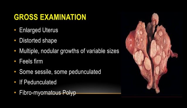 Fibromyoma uterus by Dr. H.K Cheema | PDF | Pregnancy | Reproductive Health