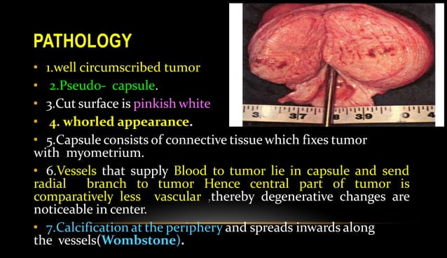 Fibromyoma uterus by Dr. H.K Cheema | PDF | Pregnancy | Reproductive Health