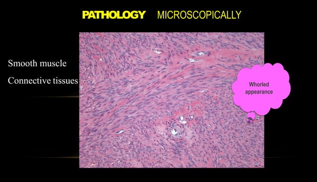 Fibromyoma uterus by Dr. H.K Cheema | PDF | Pregnancy | Reproductive Health