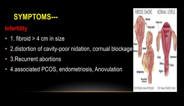 Fibromyoma uterus by Dr. H.K Cheema | PDF | Pregnancy | Reproductive Health