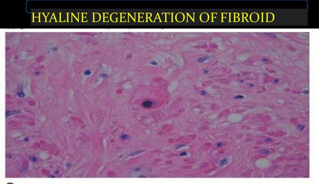 Fibromyoma uterus by Dr. H.K Cheema | PDF | Pregnancy | Reproductive Health