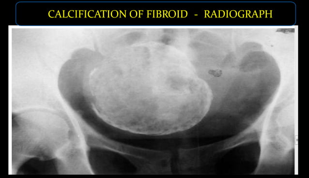 Fibromyoma uterus by Dr. H.K Cheema | PDF | Pregnancy | Reproductive Health