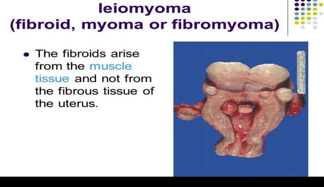 Fibromyoma uterus by Dr. H.K Cheema | PDF | Pregnancy | Reproductive Health