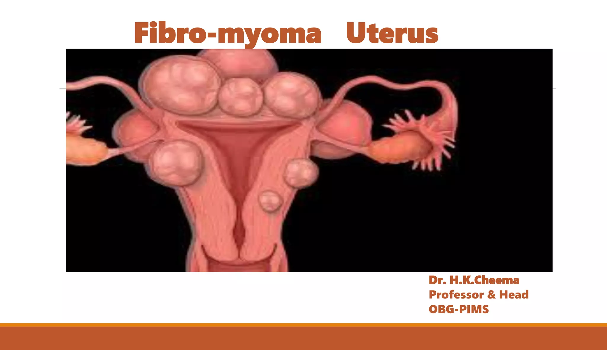 Fibromyoma uterus by Dr H.K.Cheema | PDF
