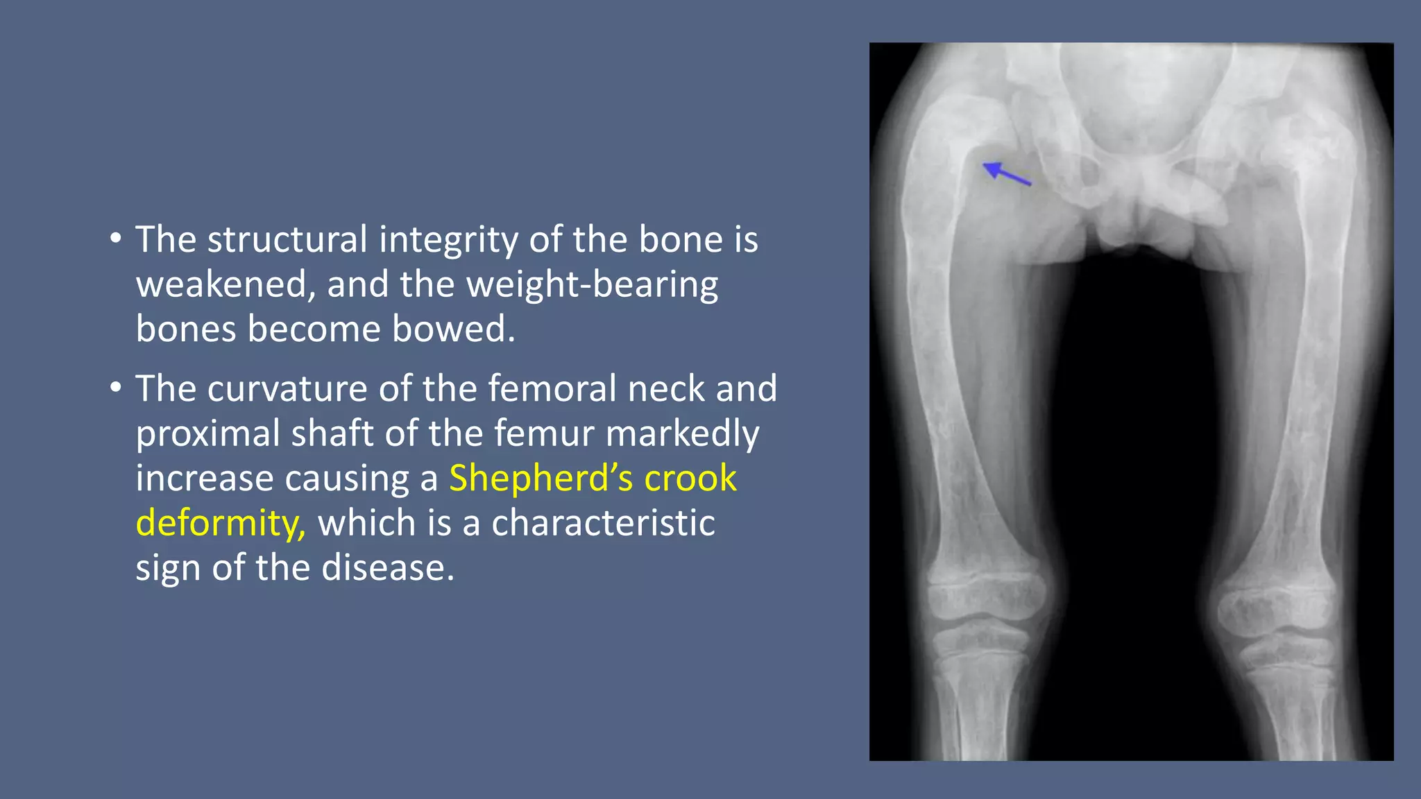 Fibro osseous lesion | PPSX