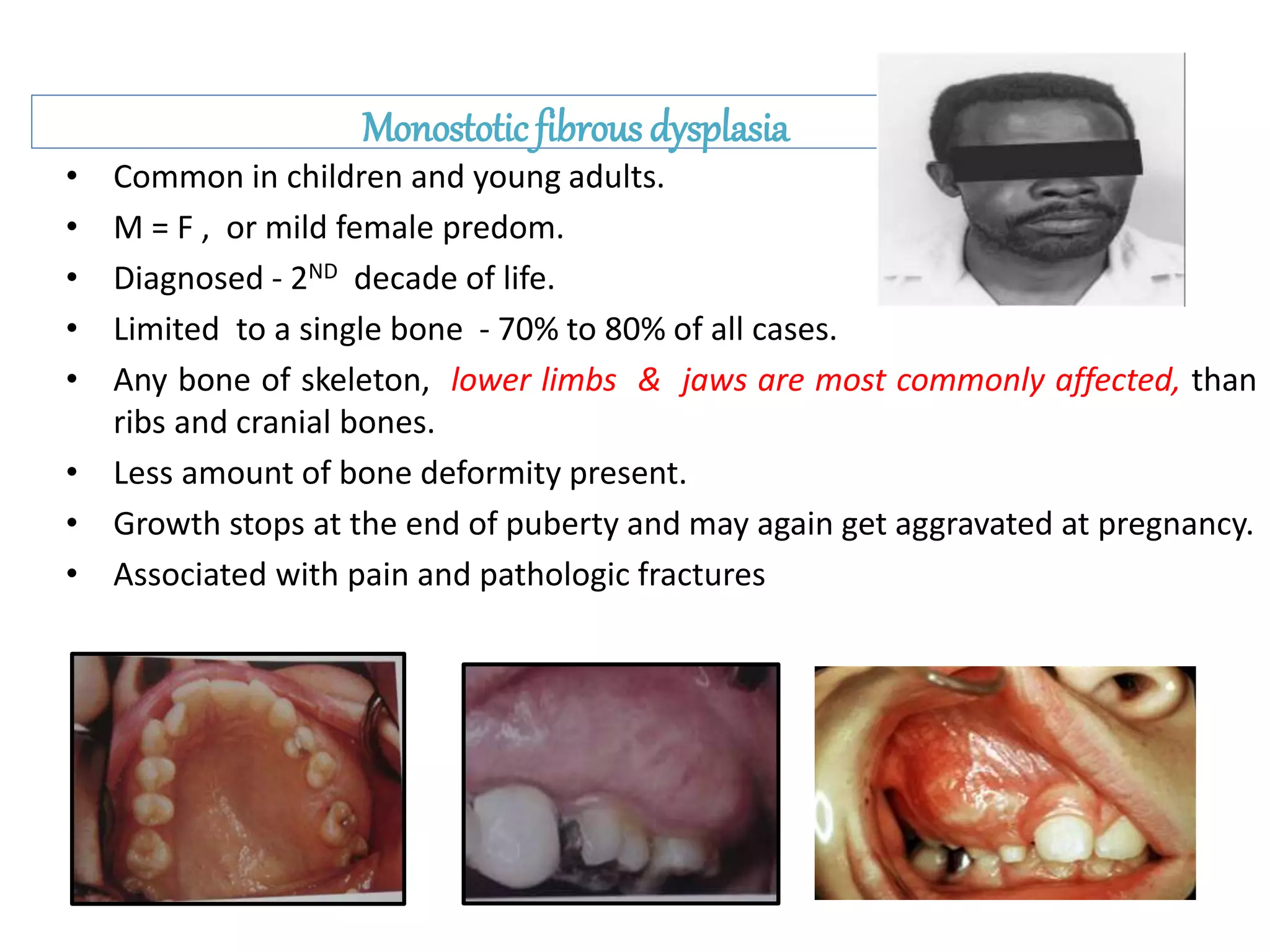 Fibroosseous lesions | PPTX