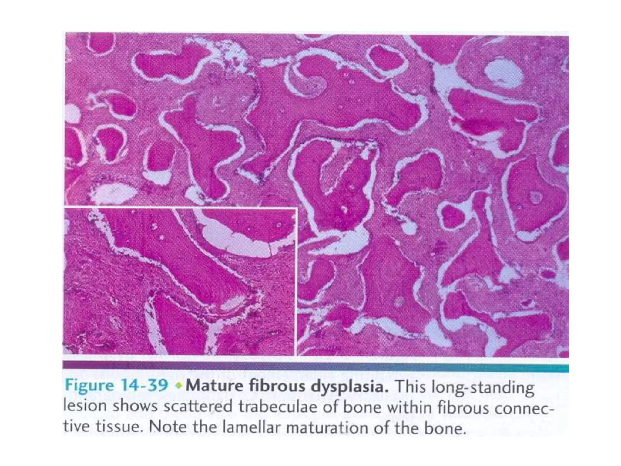 Fibro-Osseous lesions of head & neck | PPTX