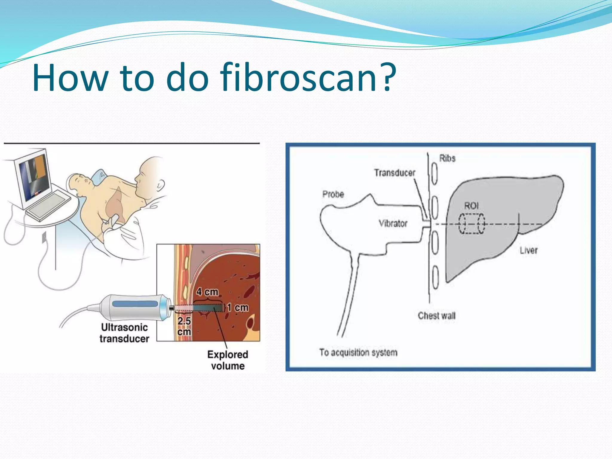 Fibroscan.dr quiyum | PPTX