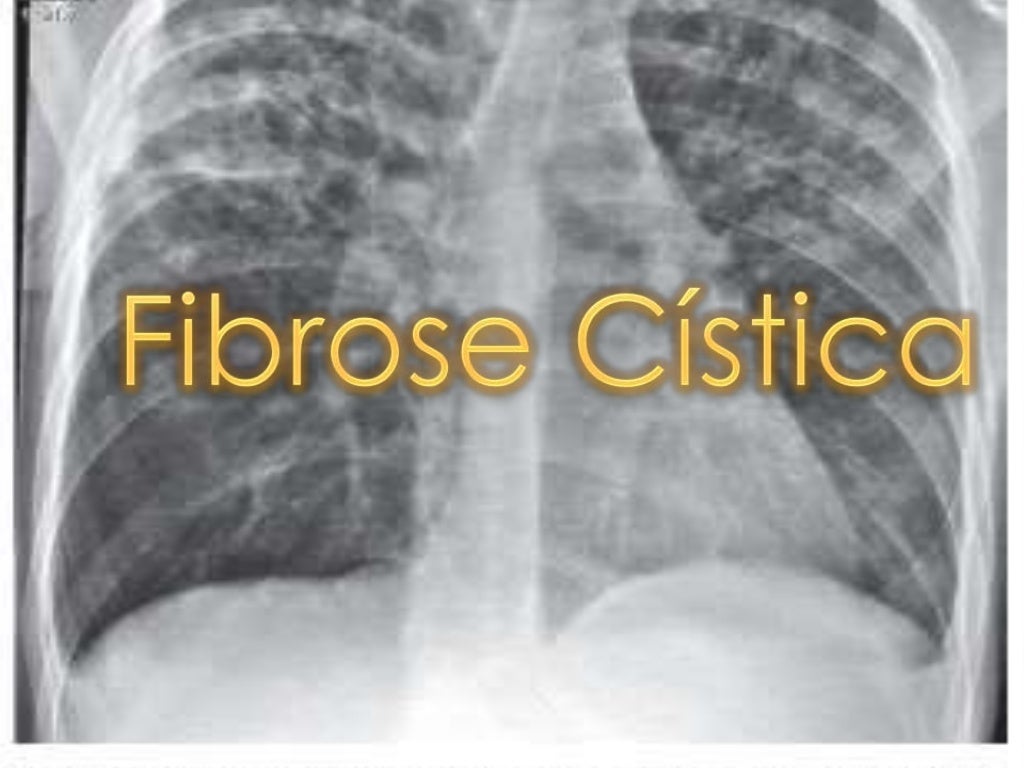Fibrose cística