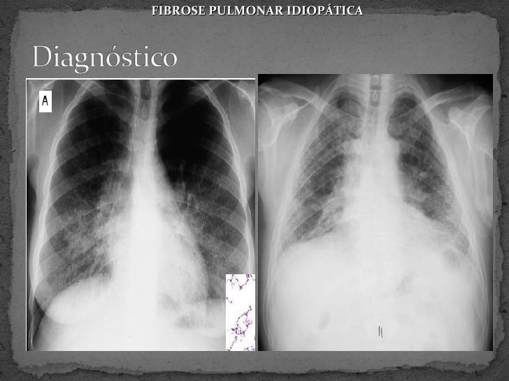 Fibrose Pulmonar Idiopatica Idiopathic Pulmonary Fibrosis Pathogenesis