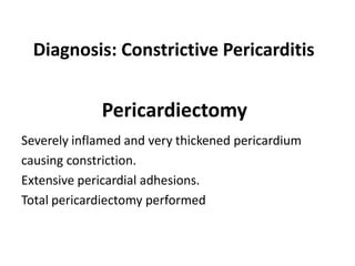 Fibrosing Mediastinitis due to IgG4 Disease | PPT
