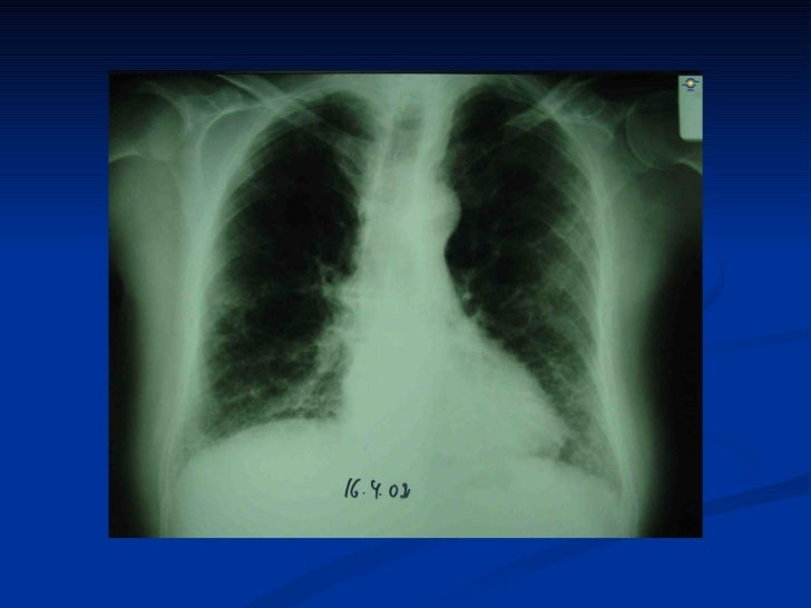 Fibrosis pulmonar idiopatica Fibrosis pulmonar idiopatica