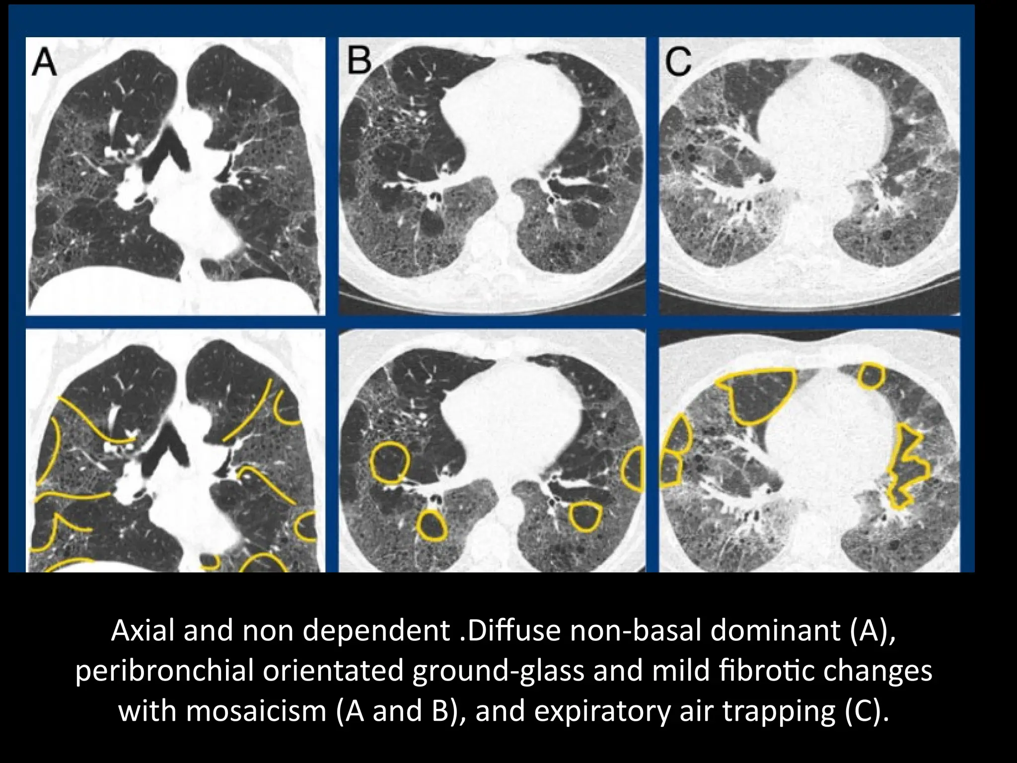 Fibrotic Hypersensitivity pneumonitis.pptx