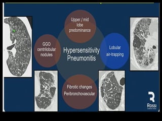Fibrotic Hypersensitivity pneumonitis.pptx