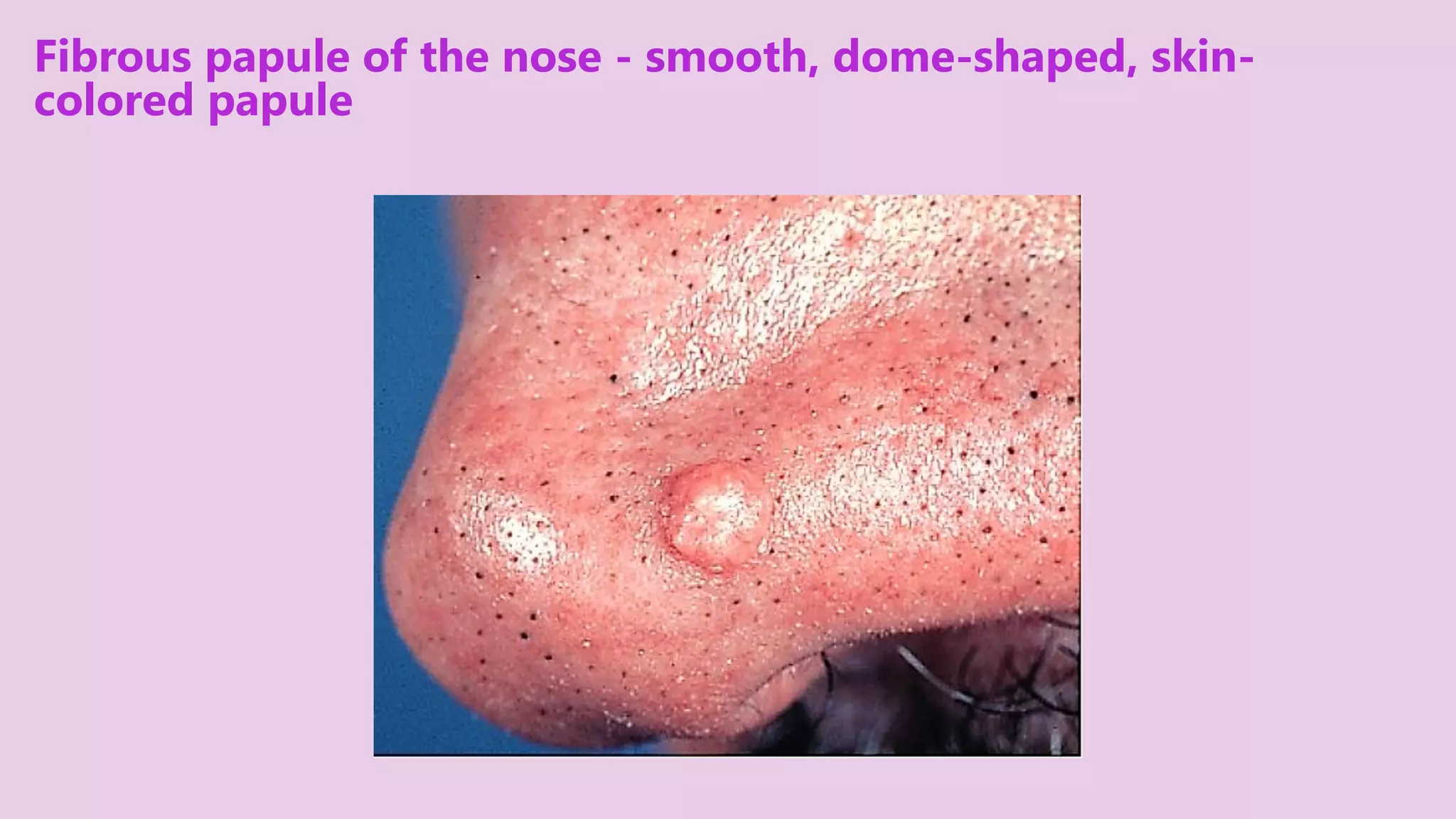 Fibrous and Fibrohistiocytic Proliferations of the Skin P1 | PDF