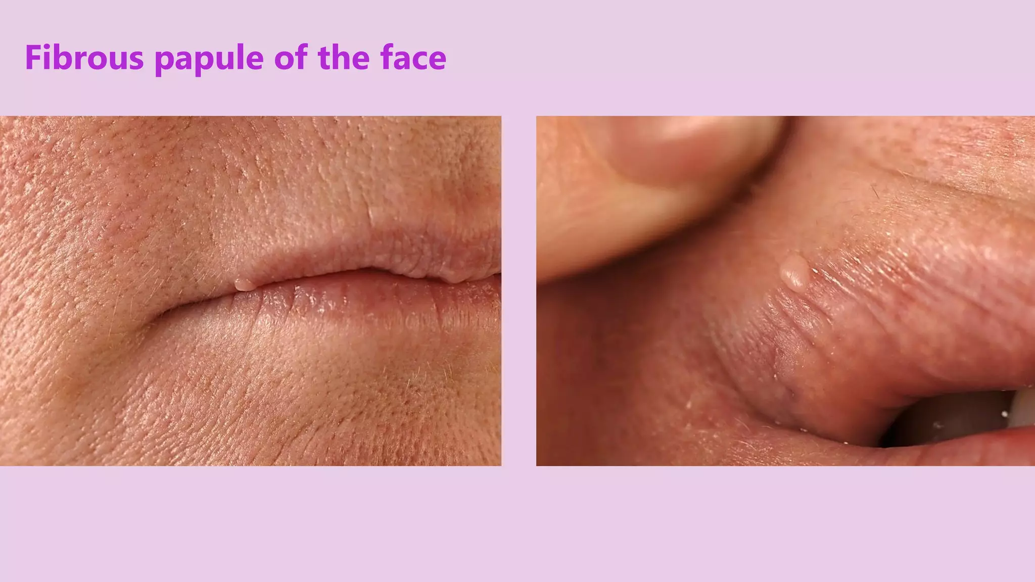 Fibrous and Fibrohistiocytic Proliferations of the Skin P1 | PDF