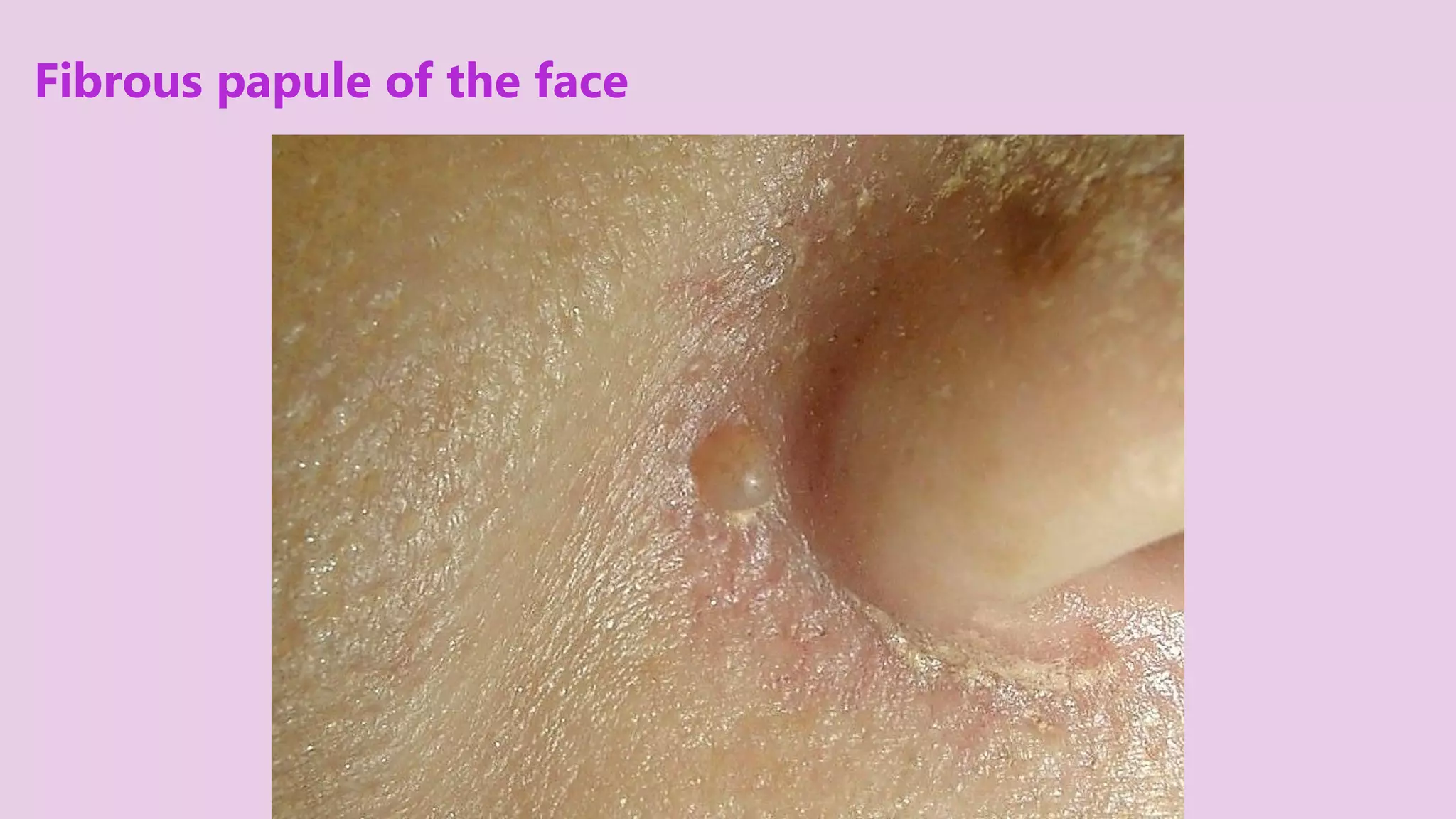 Fibrous and Fibrohistiocytic Proliferations of the Skin P1 | PDF