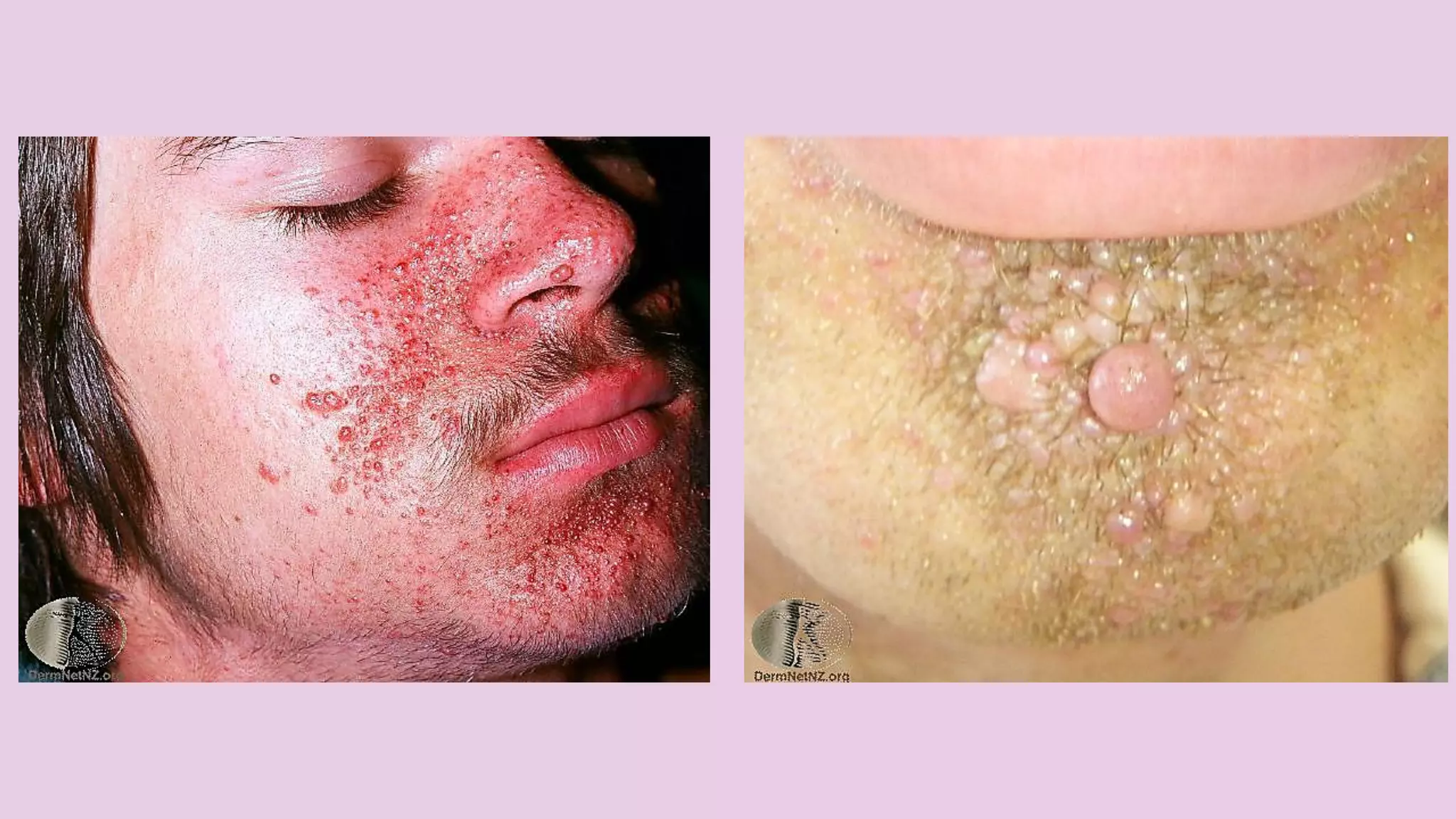 Fibrous and Fibrohistiocytic Proliferations of the Skin P1 | PDF